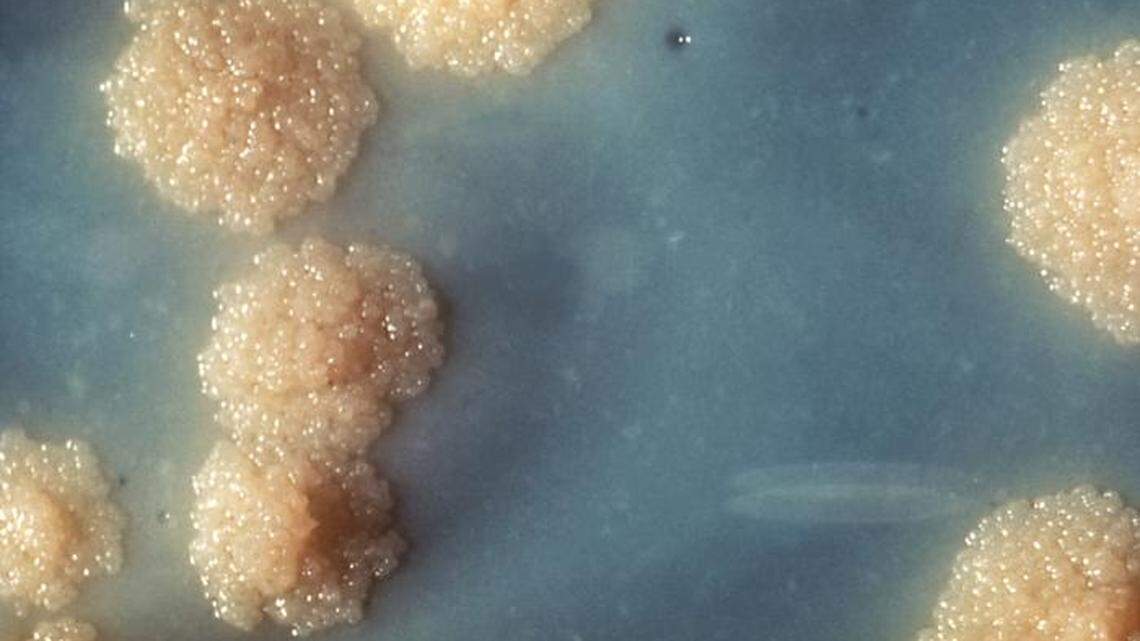 Tuberculosis in Kentucky: Outbreak, cases, symptoms, vaccine ...