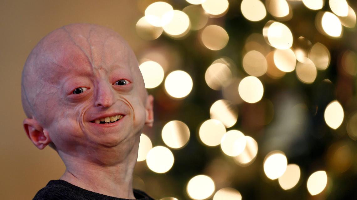 Zach Pickard, an 11-year-old with the rapid-aging disease progeria ...